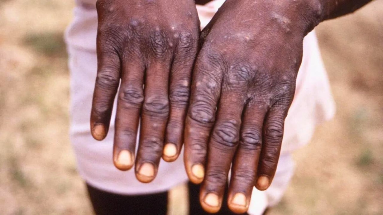 First Death Due To Mpox In Japan, Headache May Increase For WHO First Death Due To Mpox In Japan, Headache May Increase For WHO